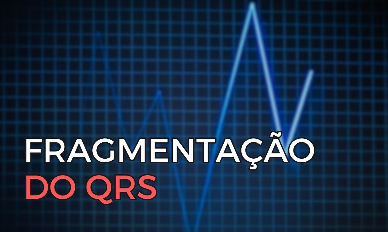 Fragmentação do QRS: Um marcador subestimado no ECG - Aprenda ECG ...